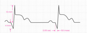 Pathological Q Wave | SkillStat