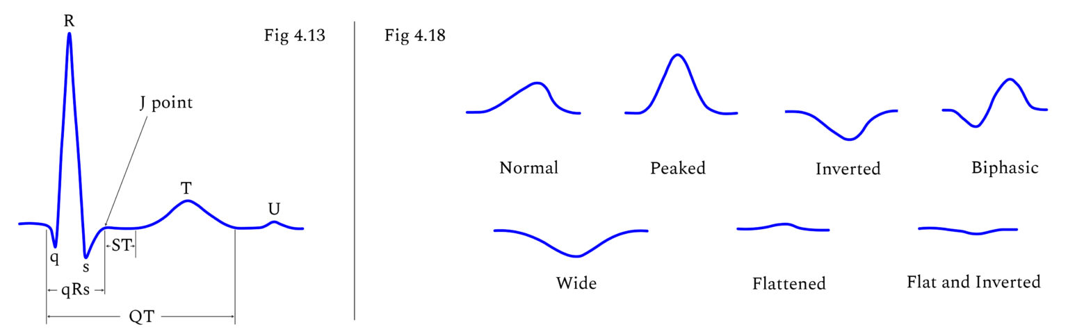 T wave inversion - SkillStat