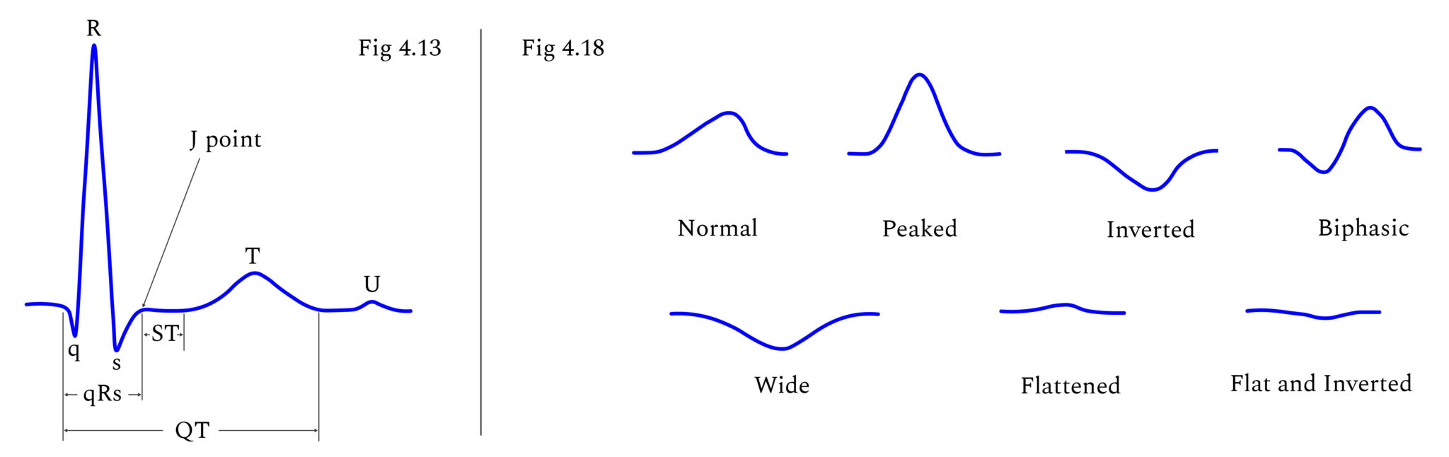 T wave inversion - SkillStat