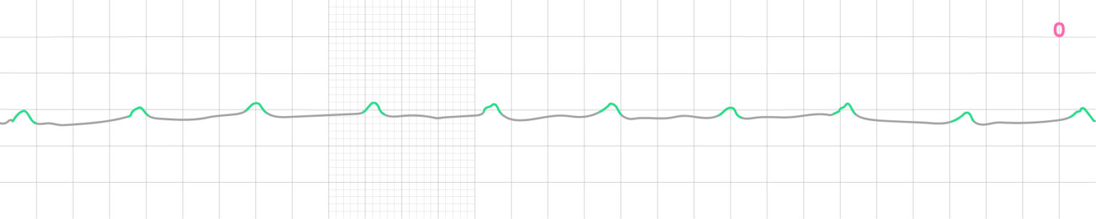 Ventricular Standstill | SkillStat