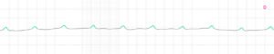 Ventricular Standstill | SkillStat
