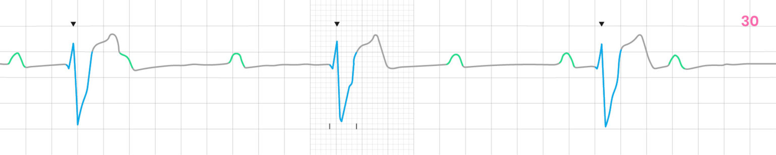 Third Degree Atrioventricular Block | SkillStat