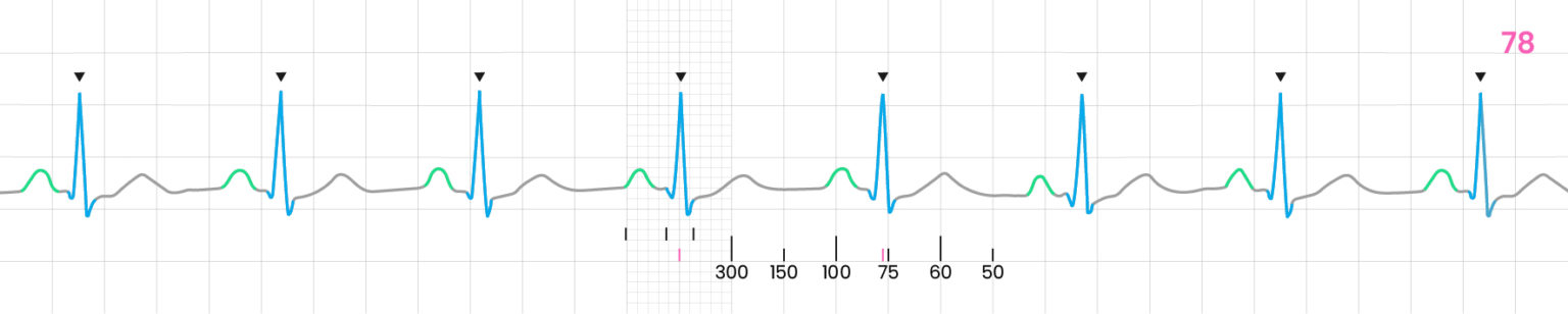 Normal Sinus Rhythm | SkillStat
