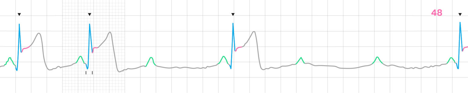 Second Degree Atrioventricular Block Type II | SkillStat