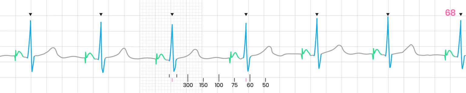 Pacemaker Spike | SkillStat