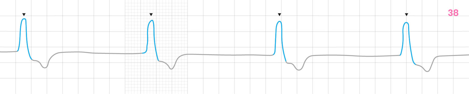 IVR (Idioventricular Rhythm) | SkillStat