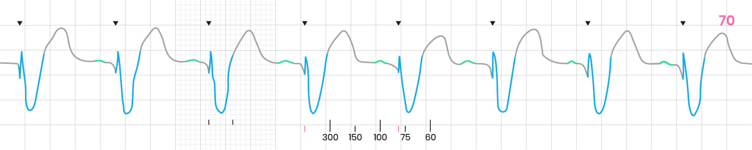 Atrial Sensed Ventricular Paced Rhythm | SkillStat