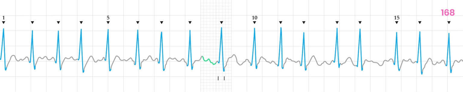 Atrial Fibrillation | SkillStat
