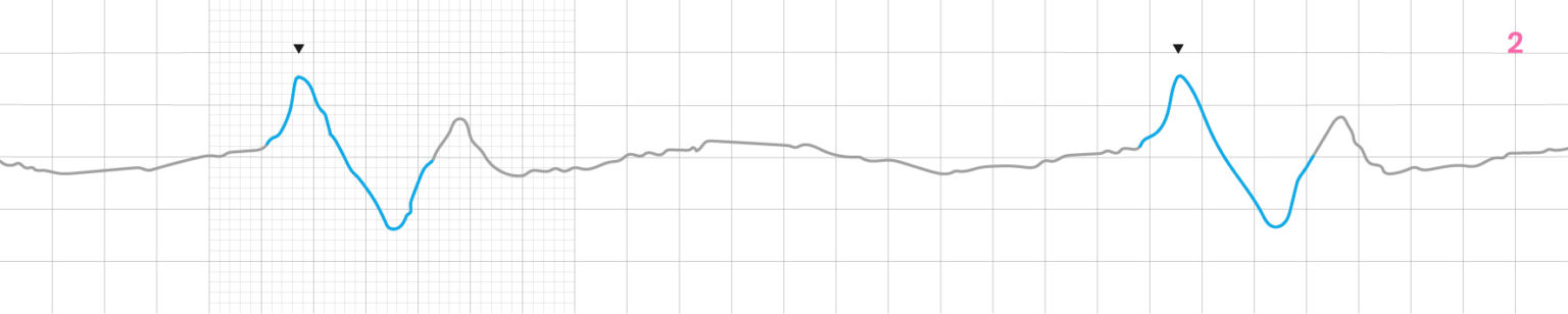 Agonal Rhythm - SkillStat
