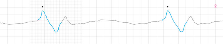 Agonal Rhythm | SkillStat