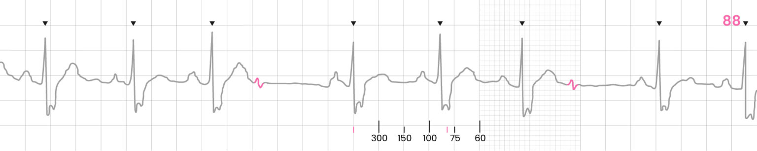 Nonconducted Premature Atrial Complex | SkillStat