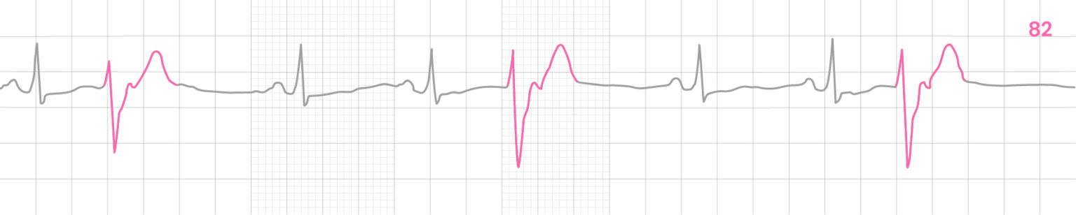 Ventricular Trigeminy | SkillStat