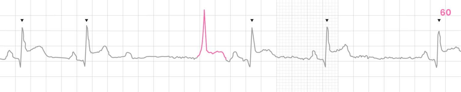 Ventricular Escape Complex | SkillStat