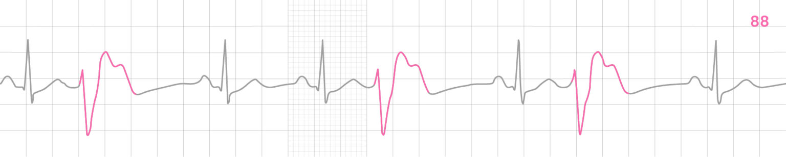 Premature Ventricular Complex | SkillStat
