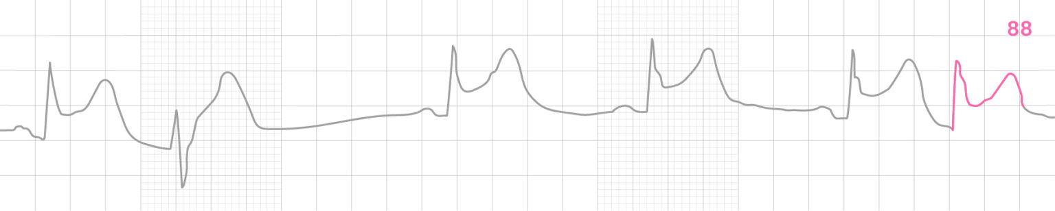 Premature Junctional Complex | SkillStat