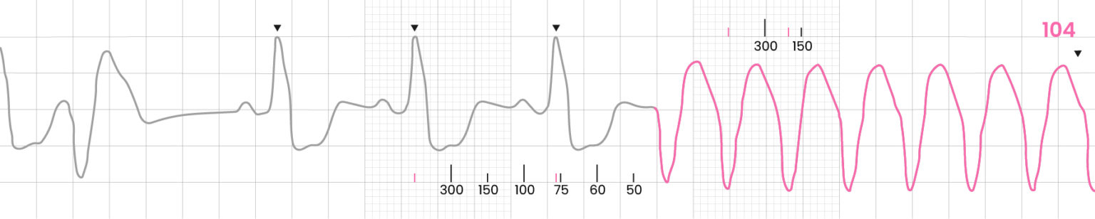 Non-Sustained Episodes of Ventricular Tachycardia | SkillStat