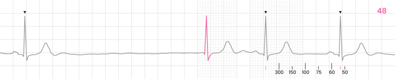 Junctional Escape Complex | SkillStat