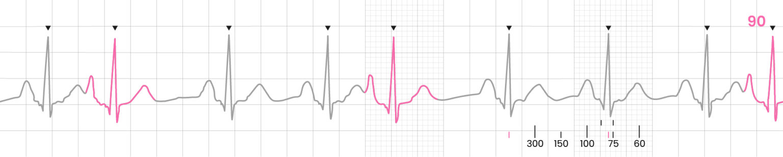 Premature Atrial Complex | SkillStat