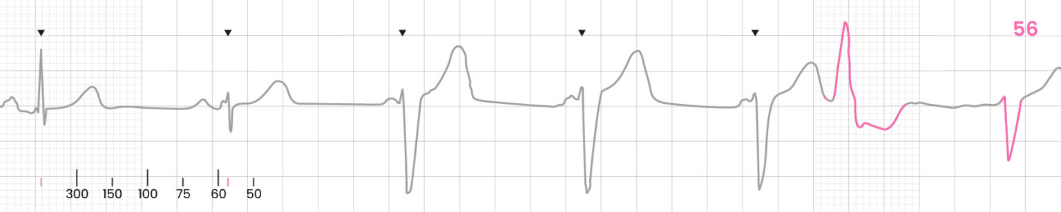 Multifocal Premature Ventricular Complex | SkillStat